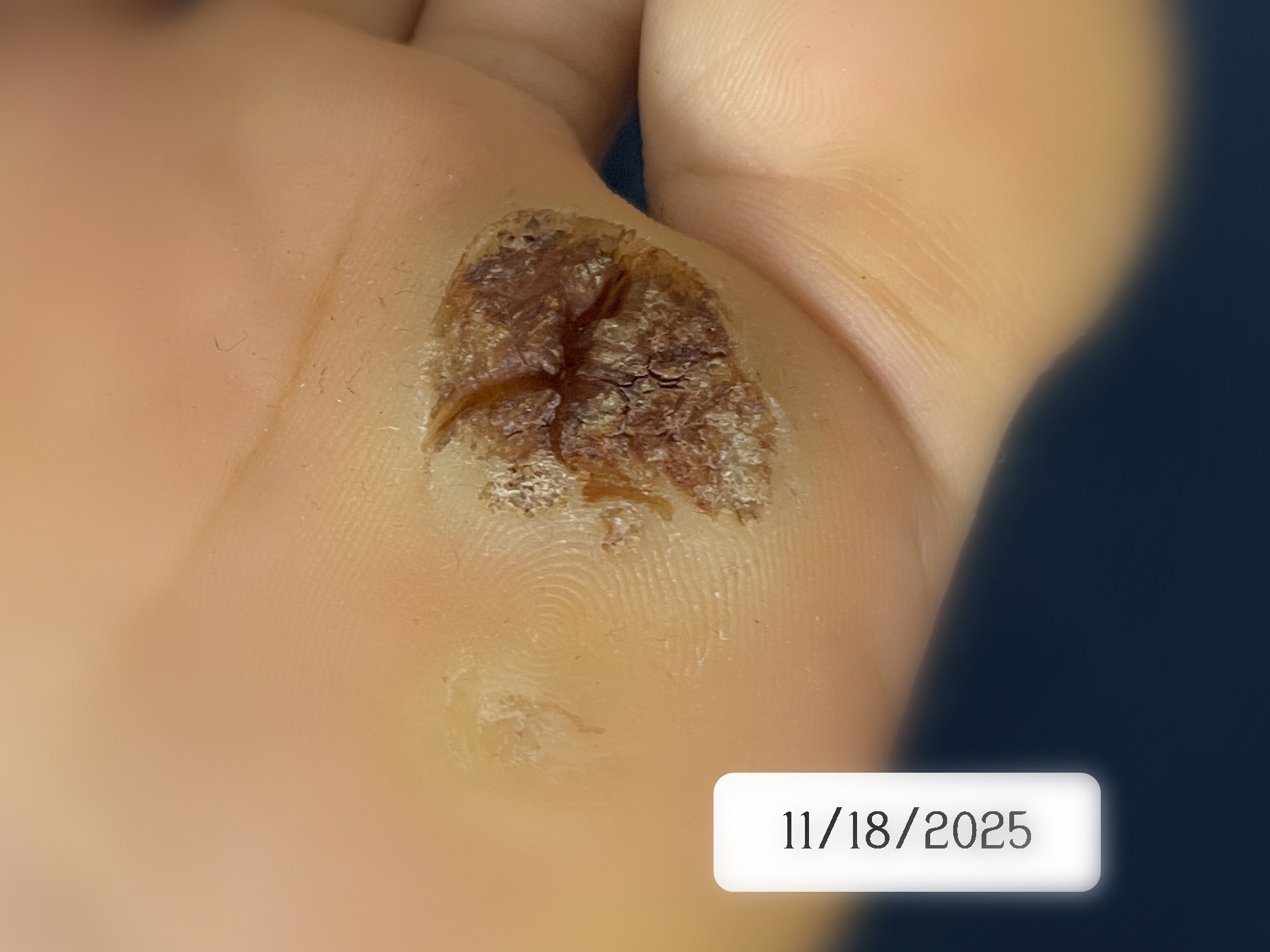 After 2 years of painful walking due to foot wart, relief came in just ...